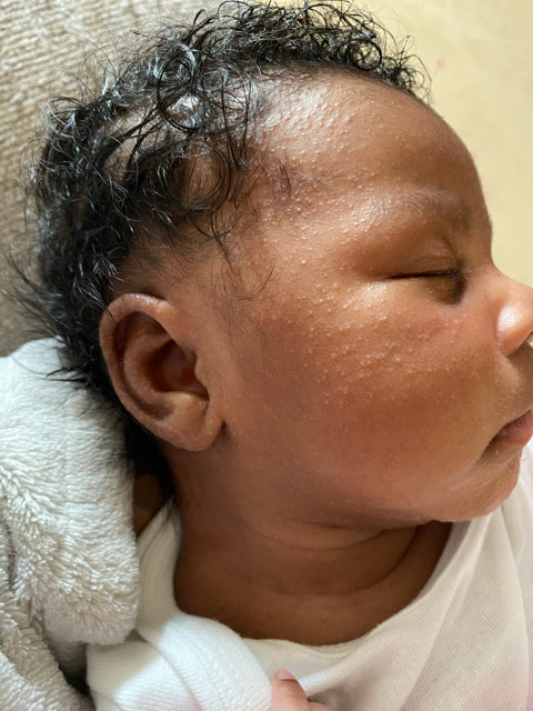 Baby Acne vs Eczema – What’s the Difference?